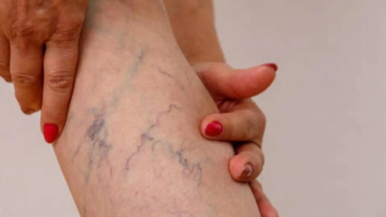 Ice-cold feet and heaviness in legs may signal varicose veins: Study ...
